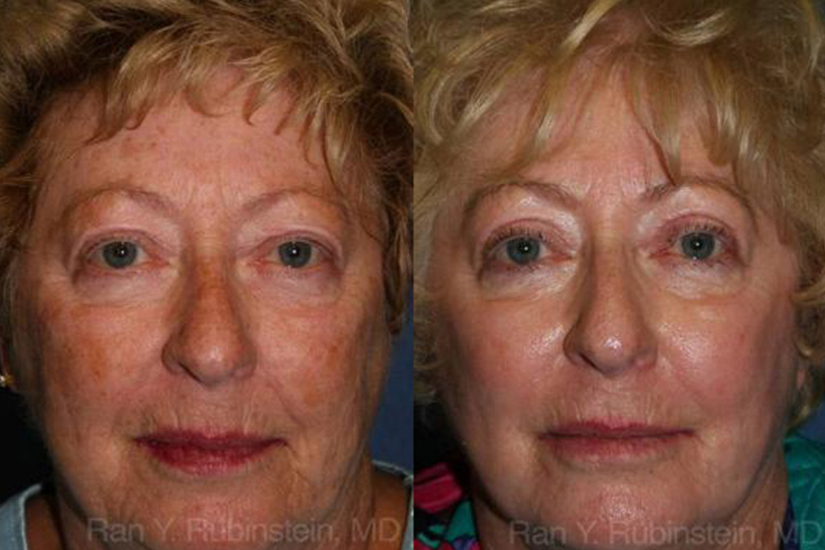 Chemical Peels | Montvale, NJ