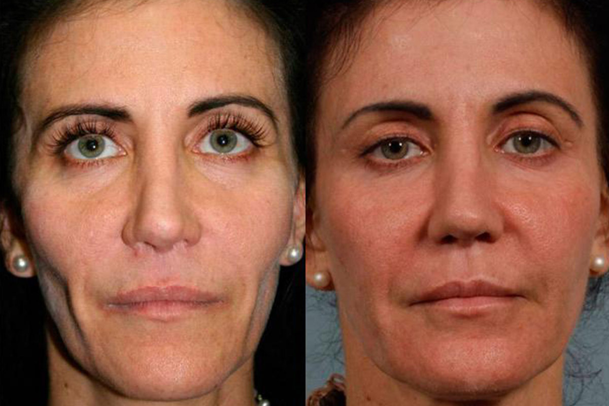 Dermal Fillers | Montvale, NJ | Facial Treatments by Dr. Ran Rubinstein