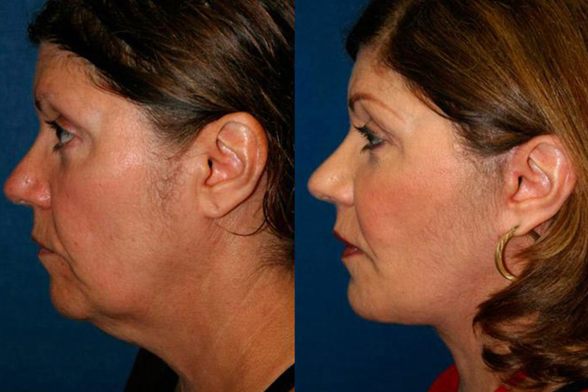 Facelift Montvale, NJ | Surgery Specialists | Full Facelift in NJ