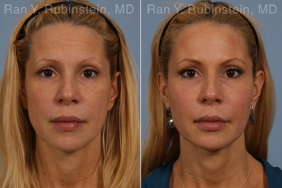 Liquid Facelift | Montvale, NJ