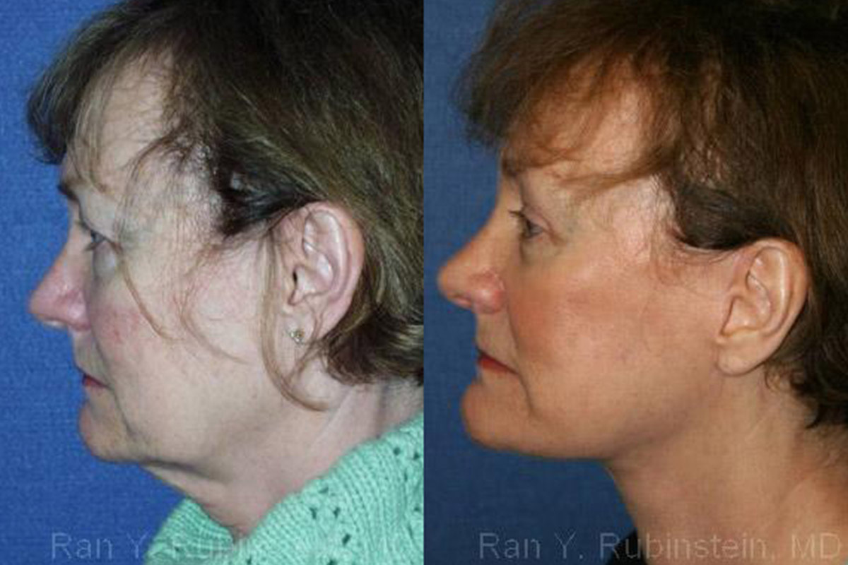 Neck Lift | Montvale, NJ