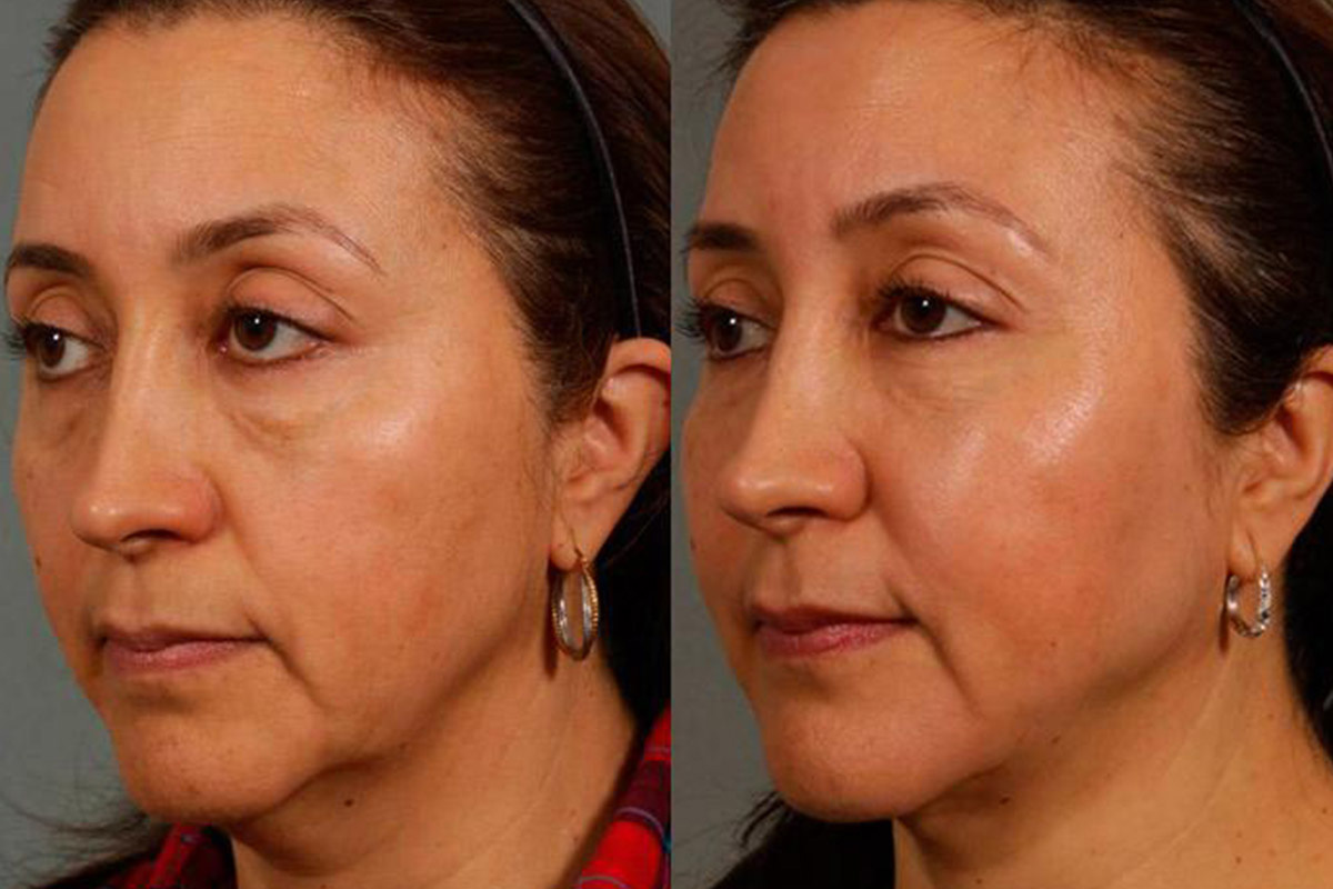 Neck Liposuction | Montvale, NJ