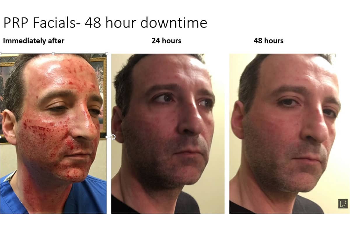 Microneedling | Montvale, NJ | Dr. Ran Rubinstein