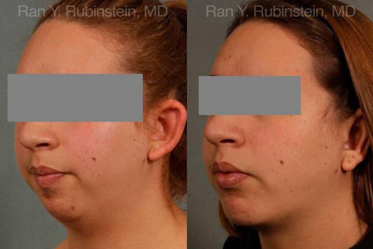 Chin Augmentation | Montvale, NJ