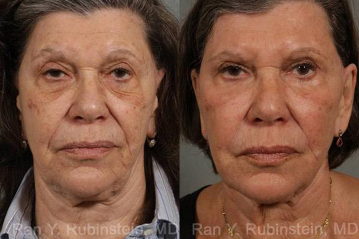 Laser Resurfacing Montvale, NJ | Montvale, NJ